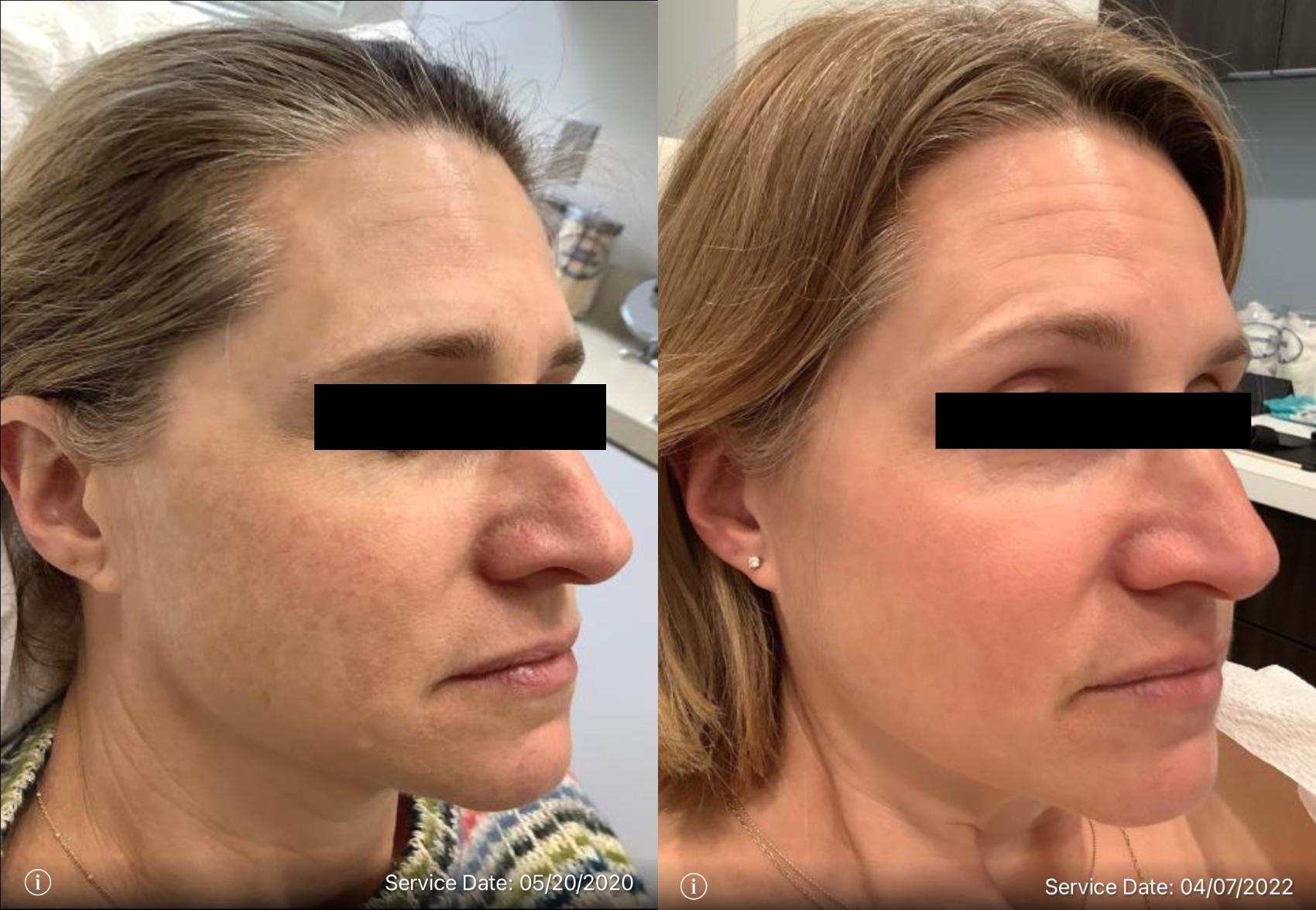 BBL Before & After Photos Patient 45 | Washington, DC | MI Skin ...