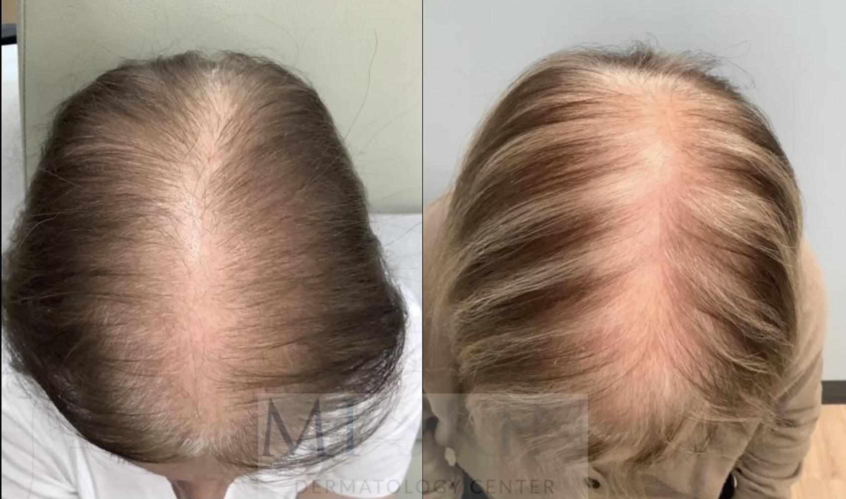 Hair Restoration Before & After Photos Patient 49 | Washington, DC | MI ...